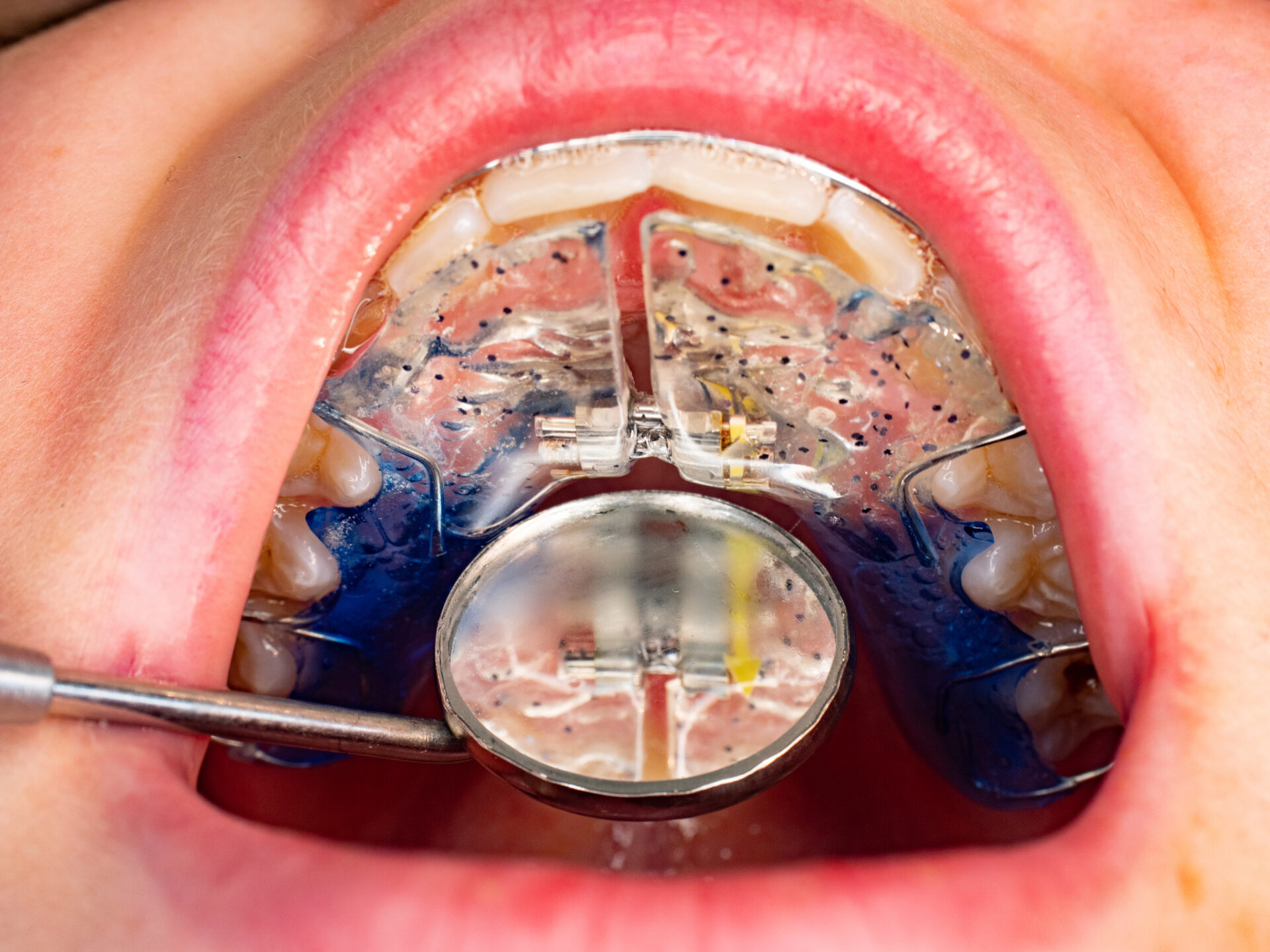 Palatal Expanders in Fort Collins and Loveland CO - Crane And Seager ...